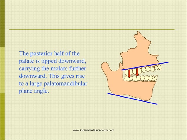 Long face syndrome | PPT | Dental Health | Diseases and Conditions