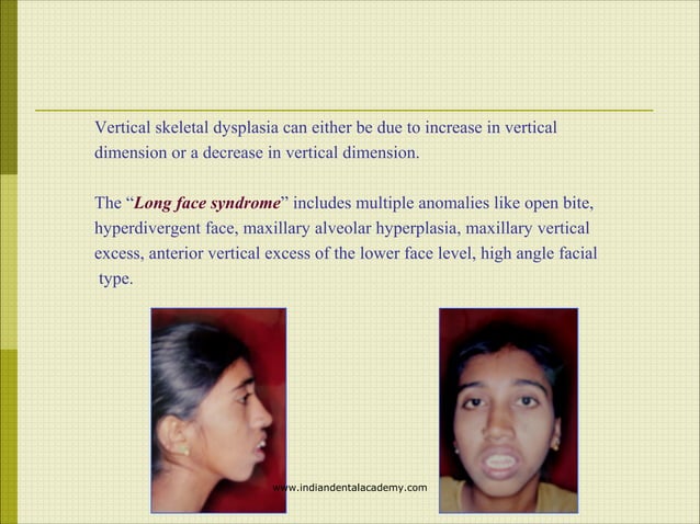 Long face syndrome | PPT | Dental Health | Diseases and Conditions