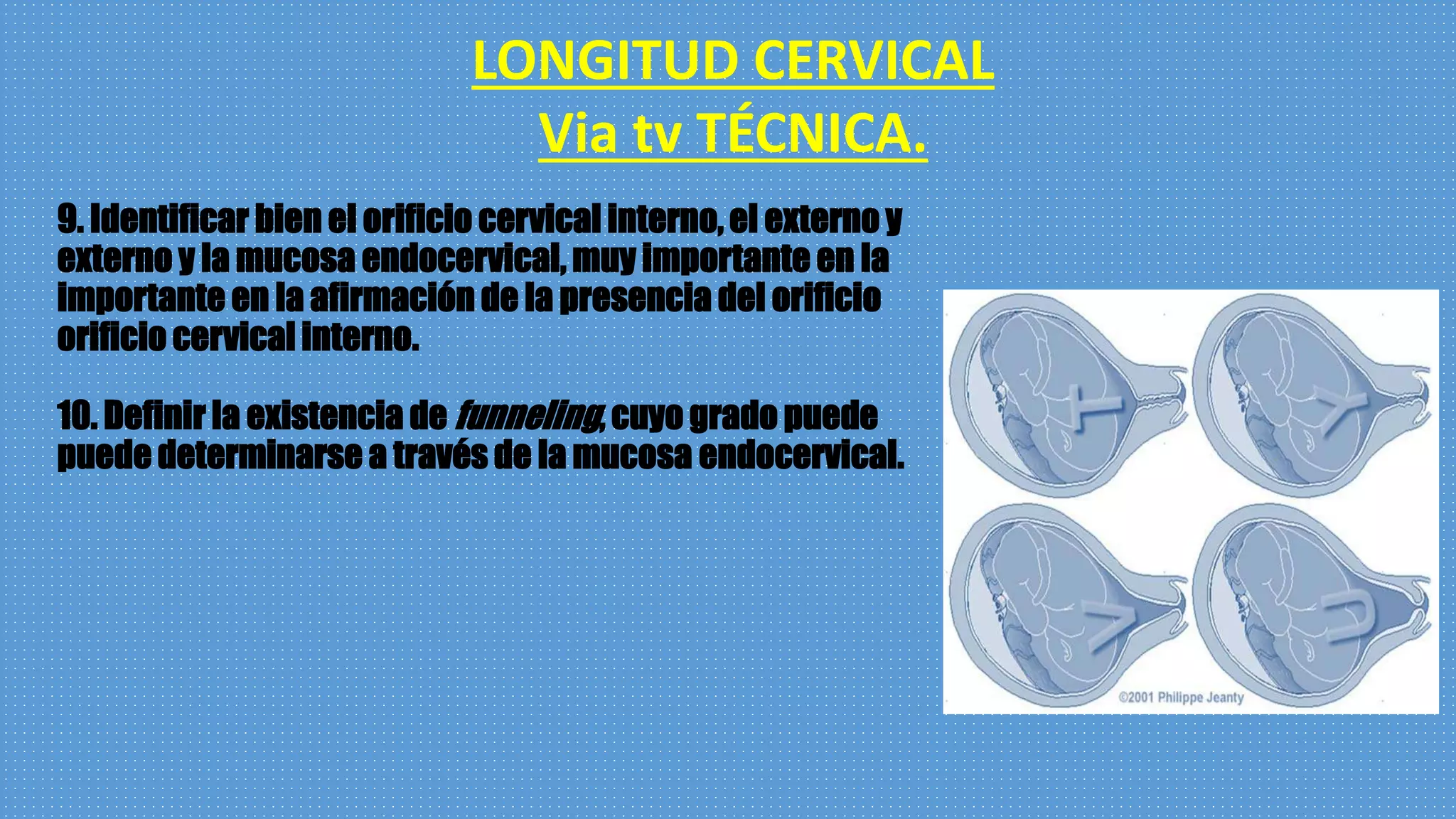 Longitud cervical en amenaza de parto pretermino y | PPT