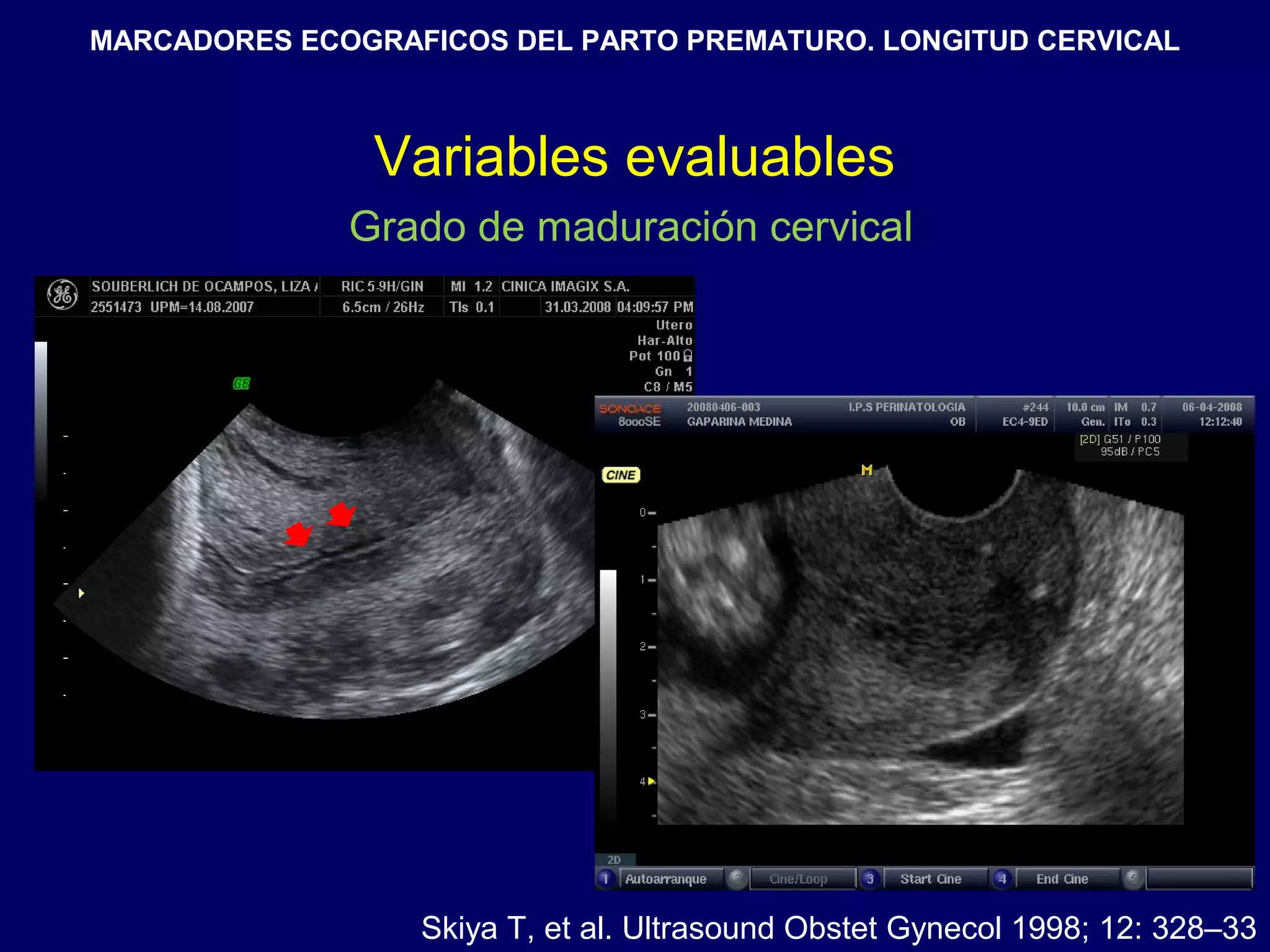 Longitud cervical, mas alla del cribado | PPT