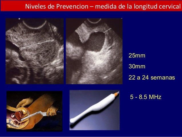 Longitud cervical, mas alla del cribado