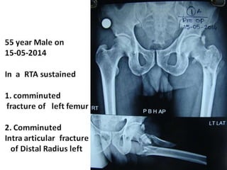 Long pfn case of vn | PPT