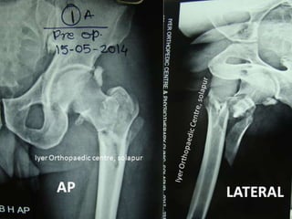 Long pfn case of vn | PPT