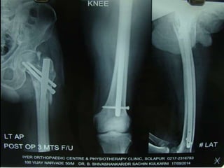 Long pfn case of vn | PPT