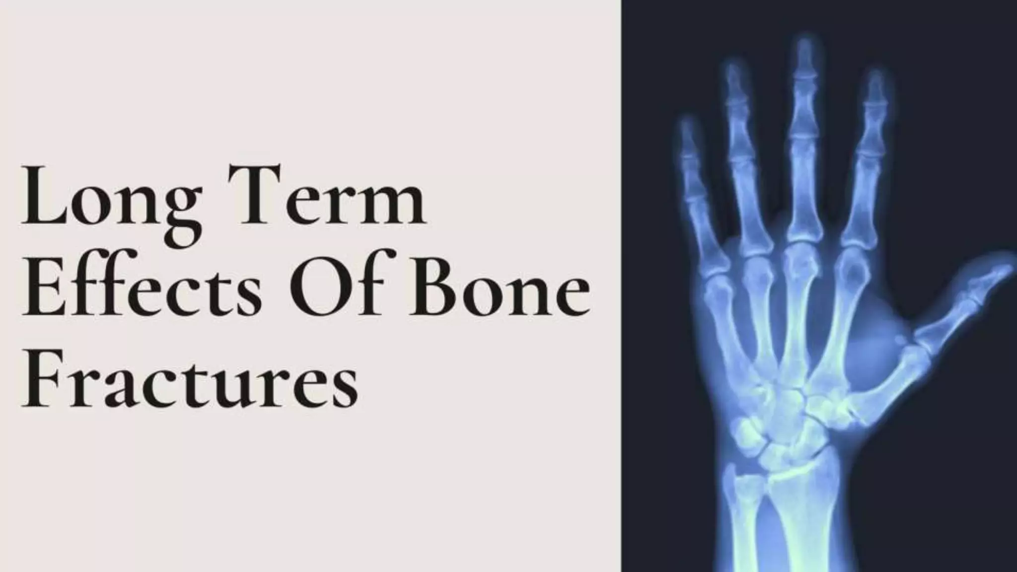 Long term effects of bone fractures | PPT
