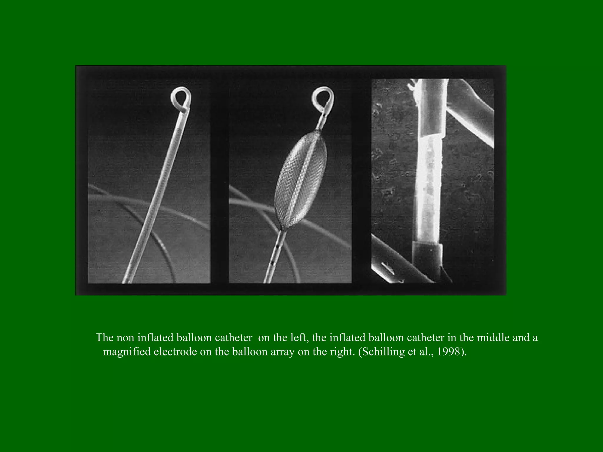 Long term post Ventricular tachycardia ablation guided by non contact ...