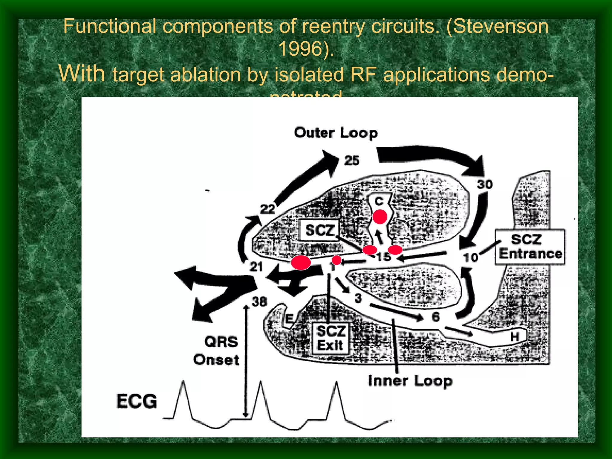 Long term post Ventricular tachycardia ablation guided by non contact ...