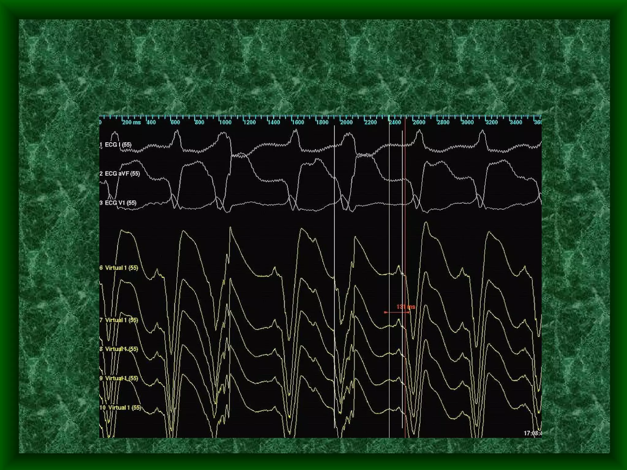 Long term post Ventricular tachycardia ablation guided by non contact ...
