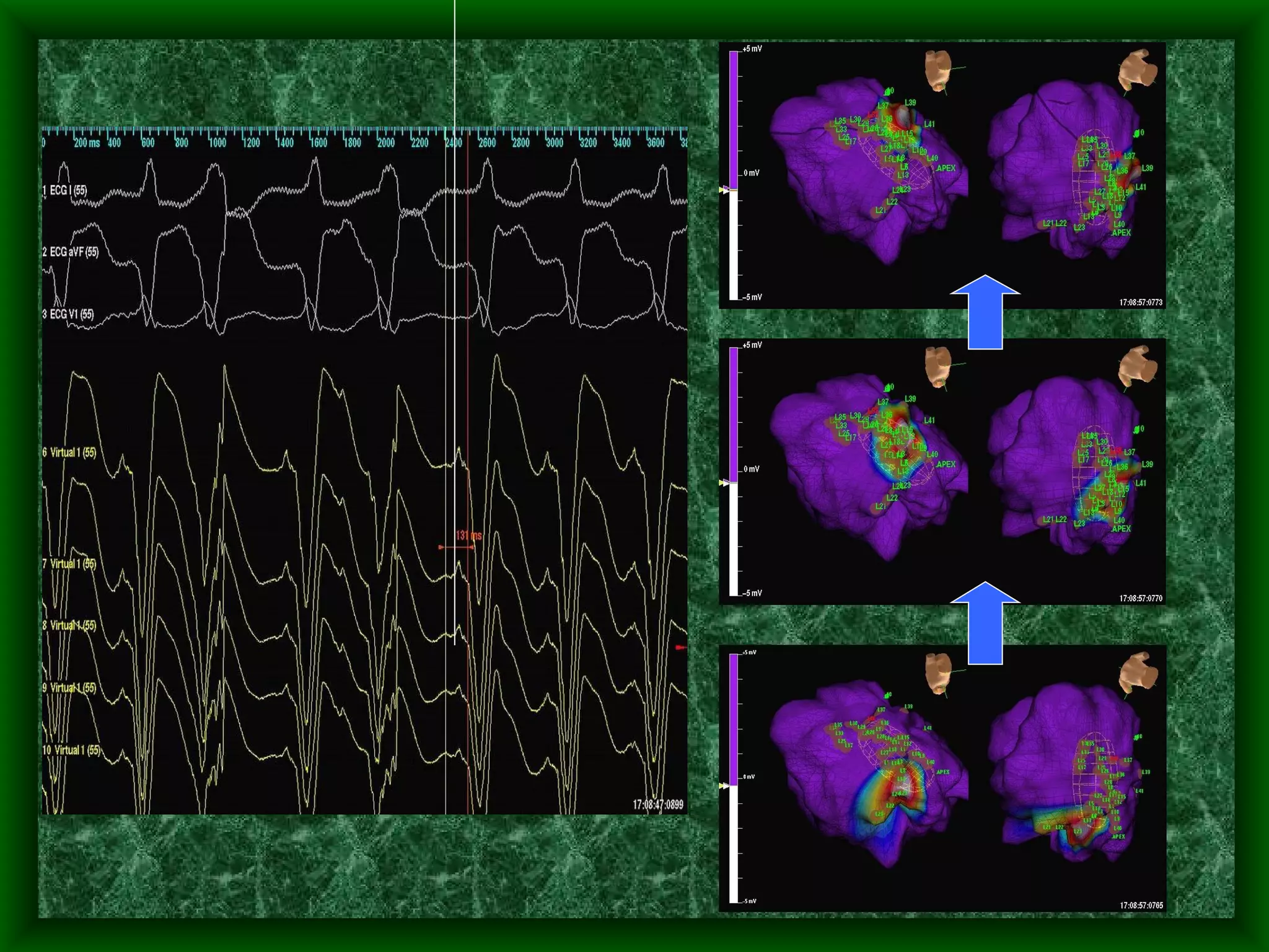 Long term post Ventricular tachycardia ablation guided by non contact ...