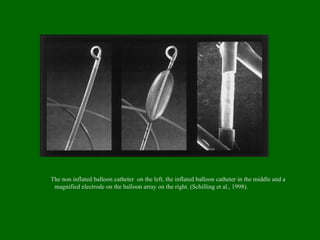 Long term post Ventricular tachycardia ablation guided by non contact ...