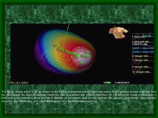 Long term post Ventricular tachycardia ablation guided by non contact ...