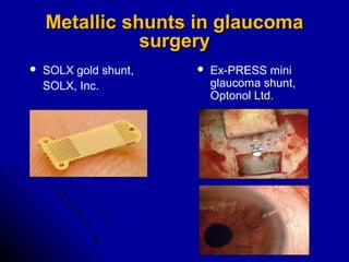 Long term results of stainless steel wire micro drainage device (sswmdd ...