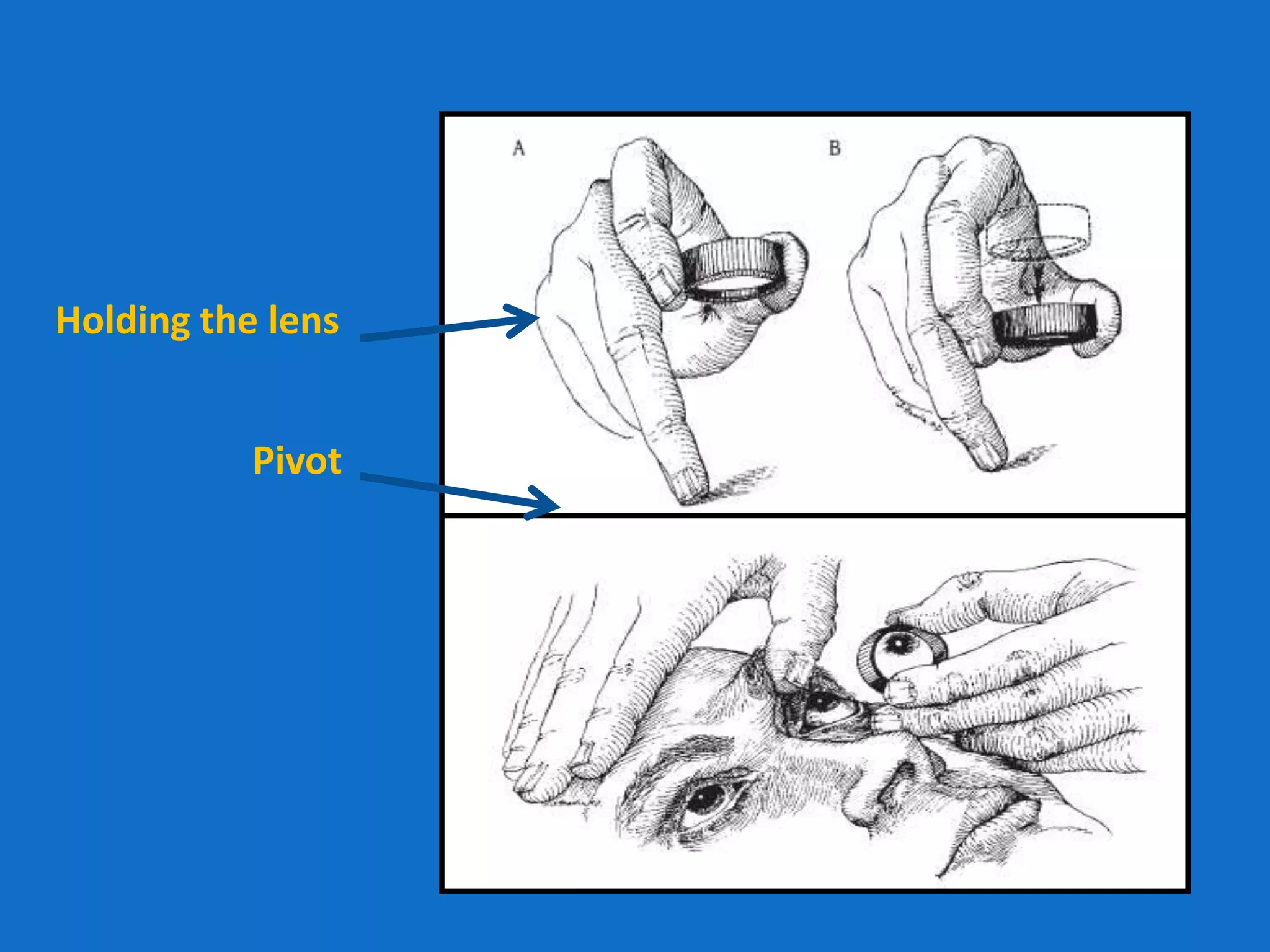 Looking deep into retina : indirect ophthalmoscopy and fundus drawing ...
