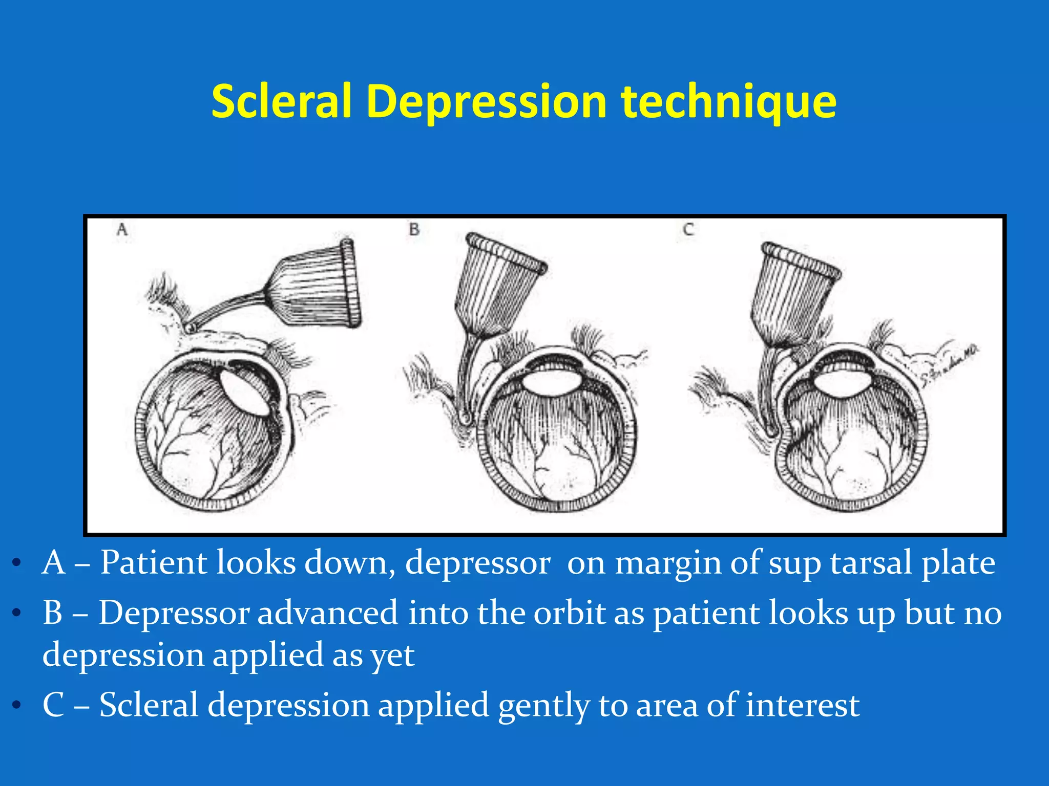 Looking deep into retina : indirect ophthalmoscopy and fundus drawing ...