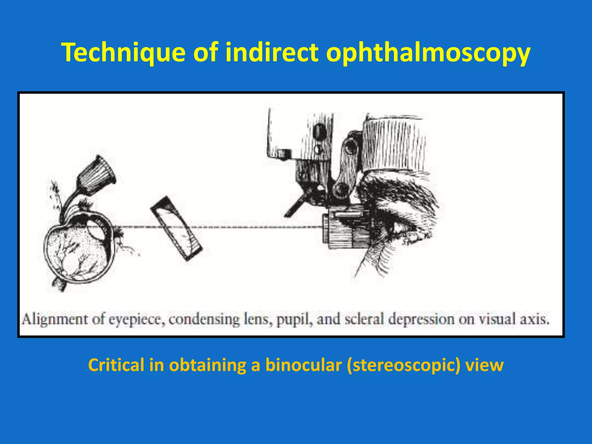 Looking deep into retina : indirect ophthalmoscopy and fundus drawing ...