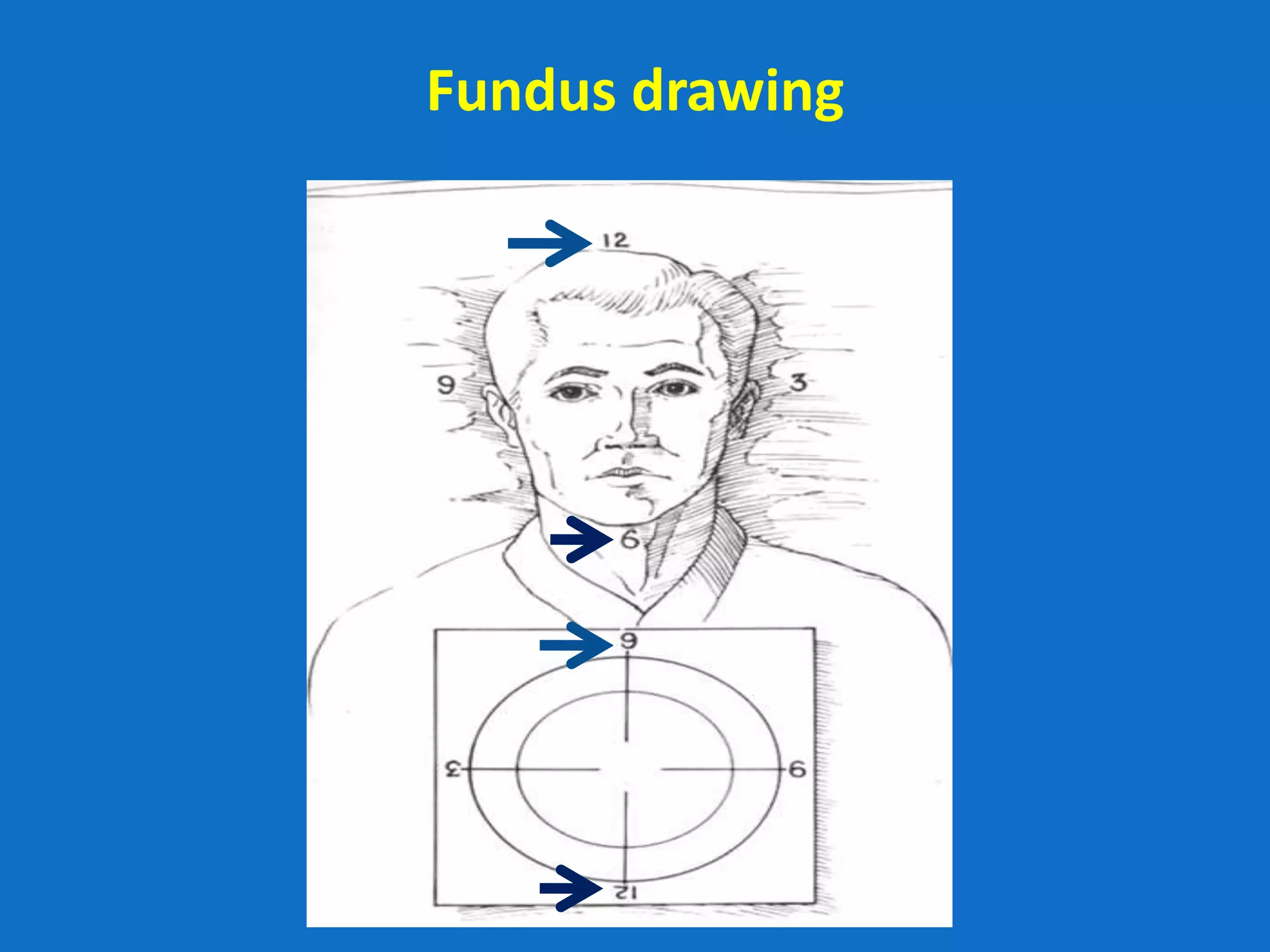 Looking deep into retina : indirect ophthalmoscopy and fundus drawing ...