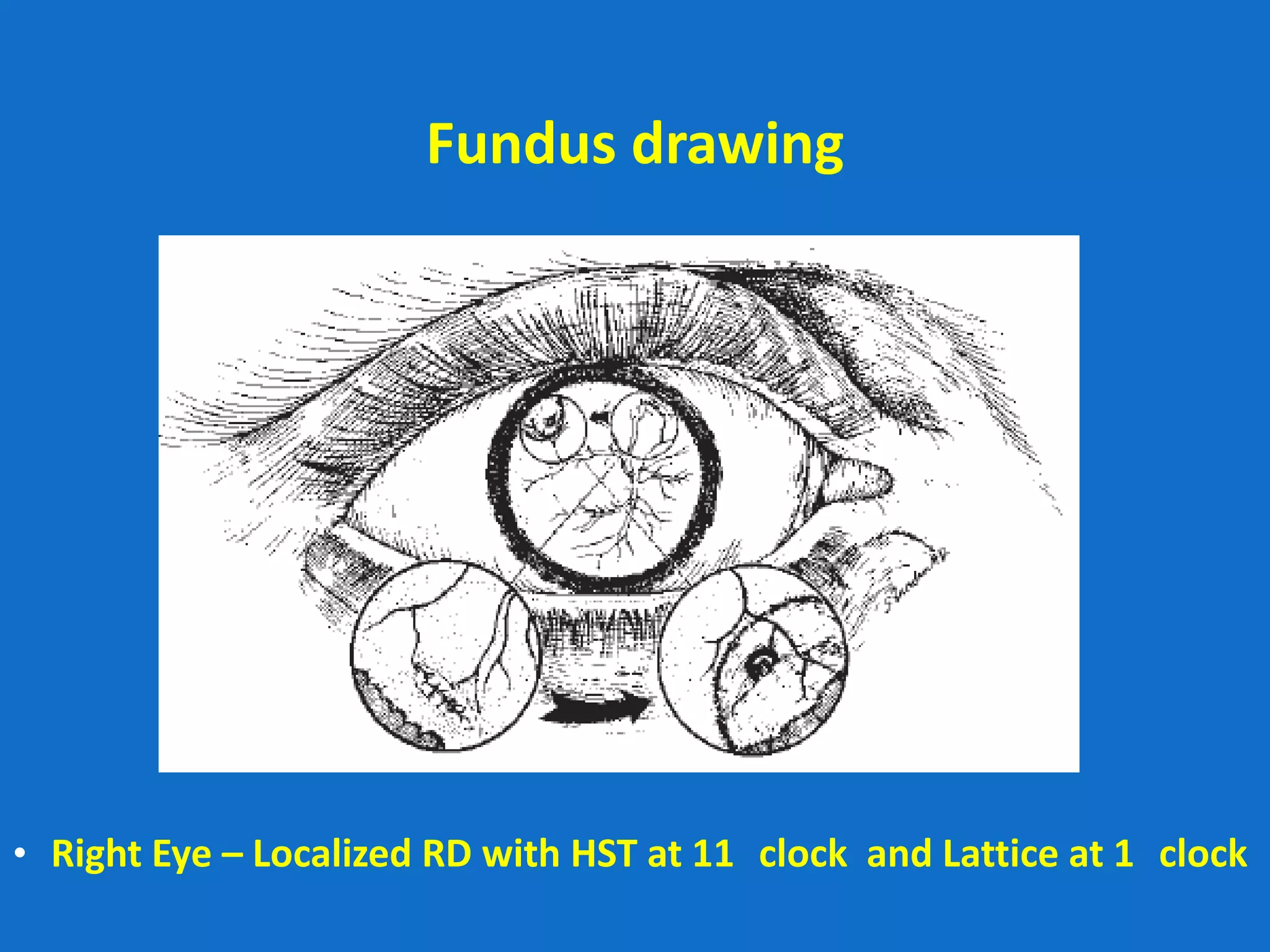 Looking deep into retina : indirect ophthalmoscopy and fundus drawing ...