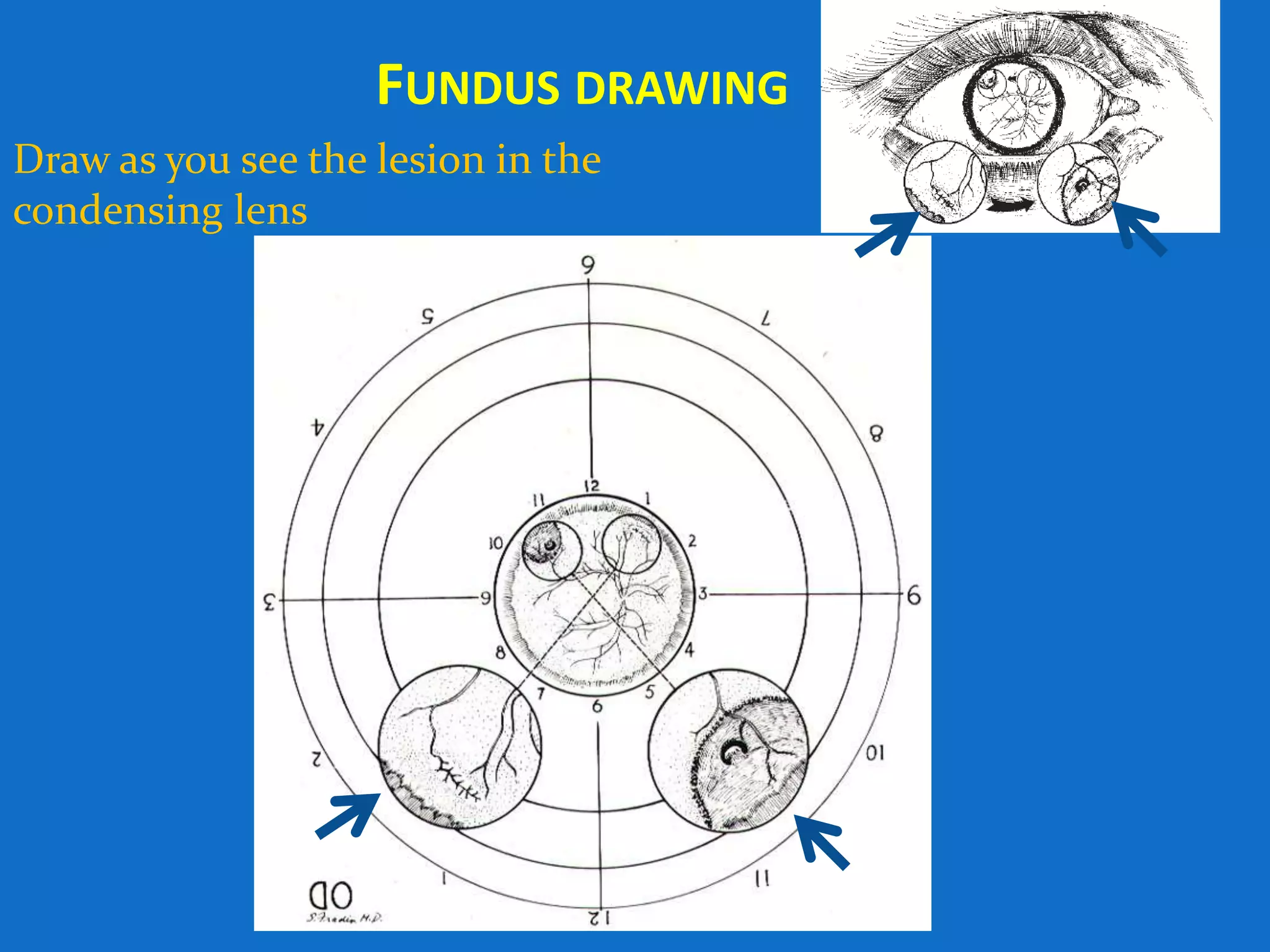 Looking deep into retina : indirect ophthalmoscopy and fundus drawing | PPT