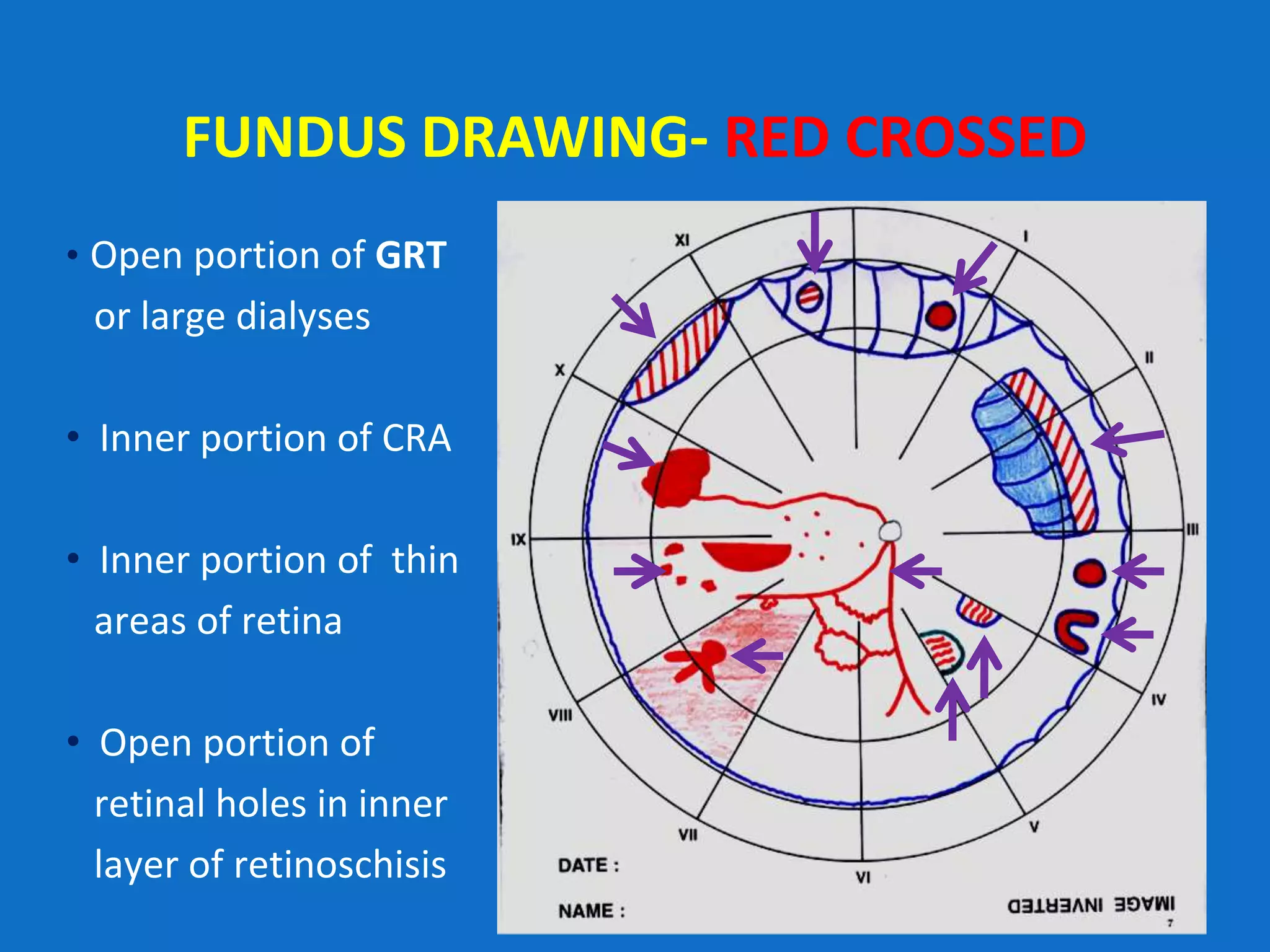 Looking deep into retina : indirect ophthalmoscopy and fundus drawing ...