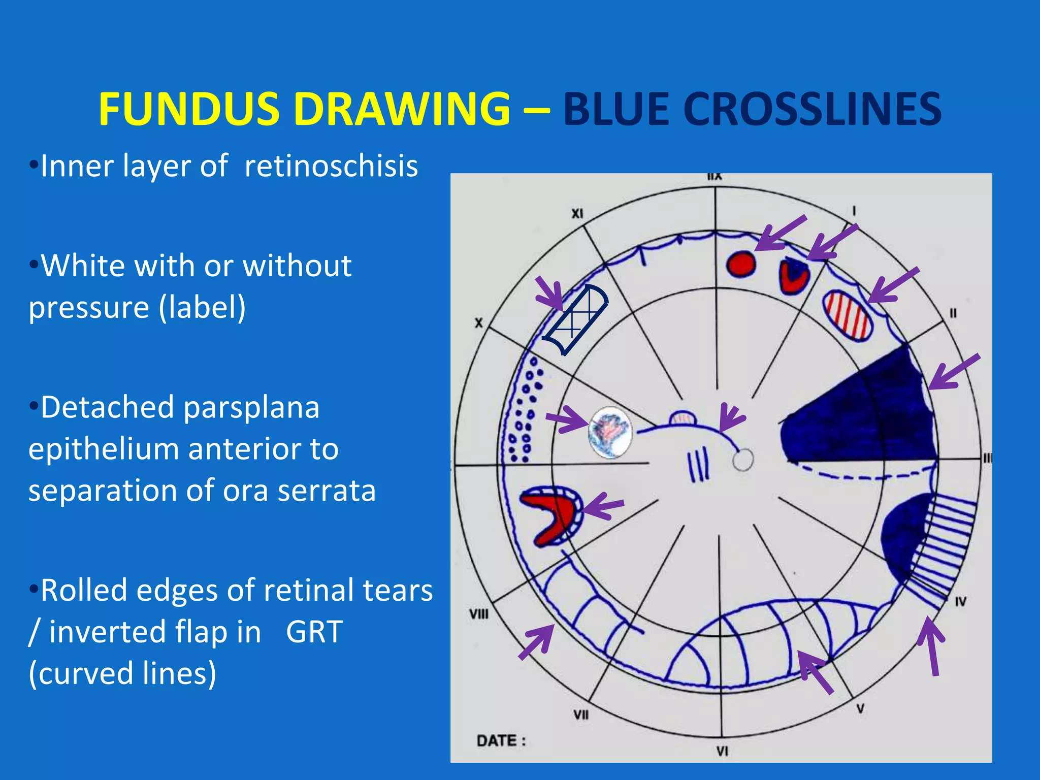 Looking deep into retina : indirect ophthalmoscopy and fundus drawing ...