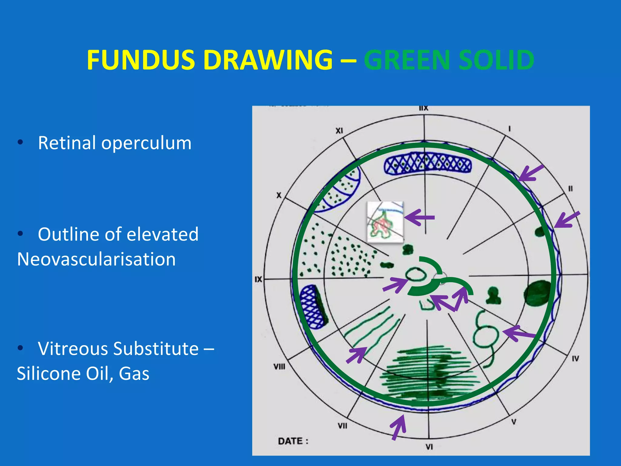 Looking deep into retina : indirect ophthalmoscopy and fundus drawing ...
