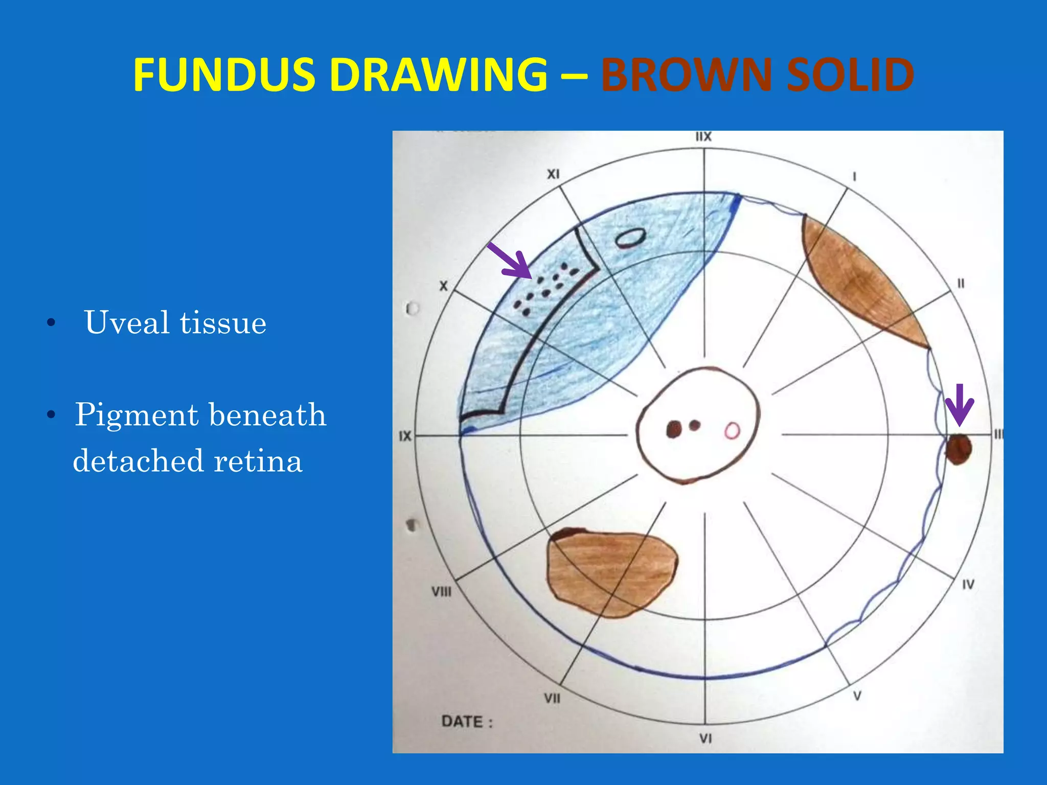 Looking deep into retina : indirect ophthalmoscopy and fundus drawing ...