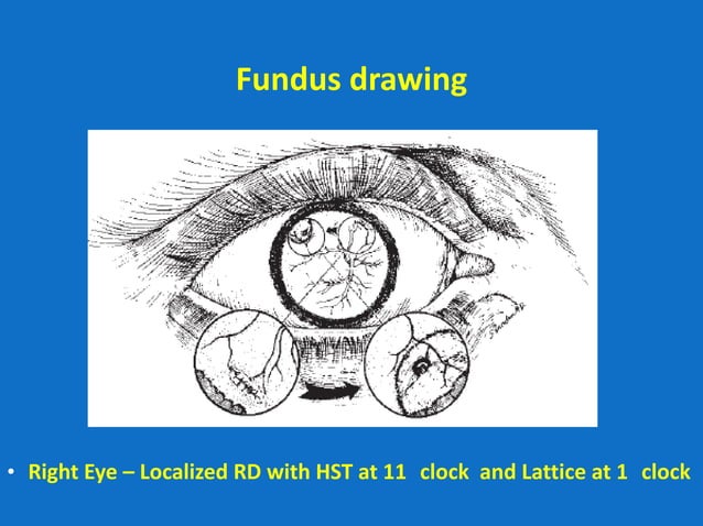 Looking deep into retina : indirect ophthalmoscopy and fundus drawing ...