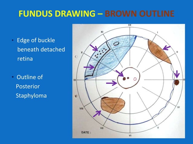 Looking deep into retina : indirect ophthalmoscopy and fundus drawing ...