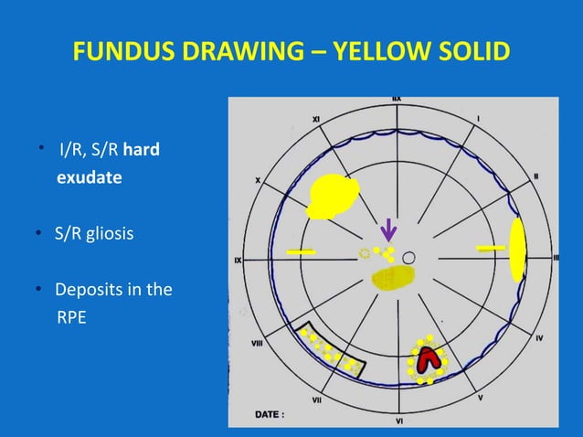Looking deep into retina : indirect ophthalmoscopy and fundus drawing ...