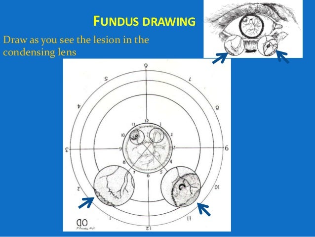 Looking deep into retina : indirect ophthalmoscopy and fundus drawing