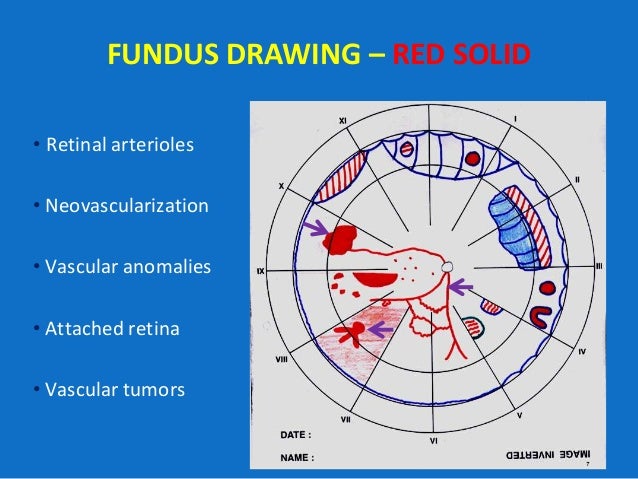 Looking deep into retina : indirect ophthalmoscopy and fundus drawing