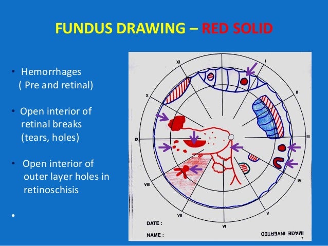 Looking deep into retina : indirect ophthalmoscopy and fundus drawing