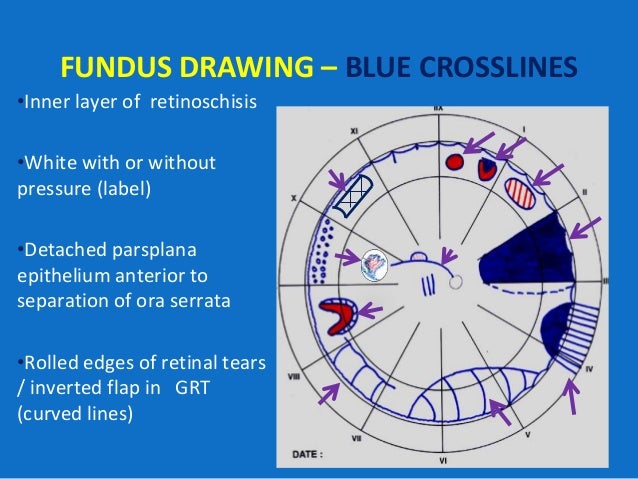 Looking deep into retina : indirect ophthalmoscopy and fundus drawing