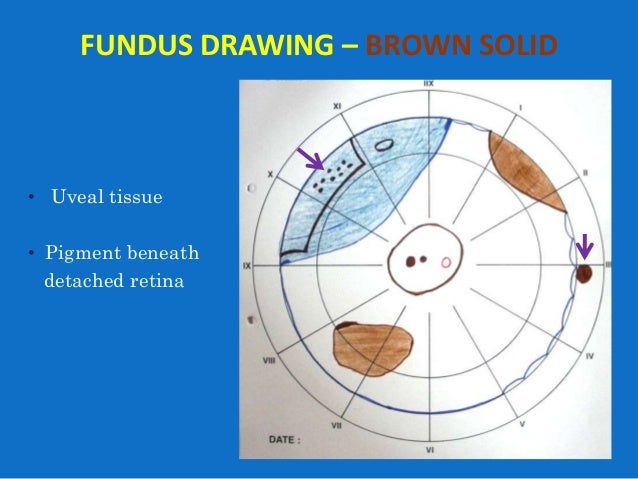 Looking deep into retina : indirect ophthalmoscopy and fundus drawing