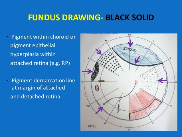 Looking deep into retina : indirect ophthalmoscopy and fundus drawing