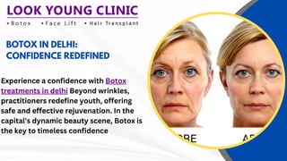 Transform Your Look with Expert Botox Treatment | PPT
