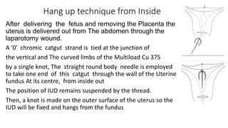 Loop (device orsystem) insertion during cesarean section | PPT