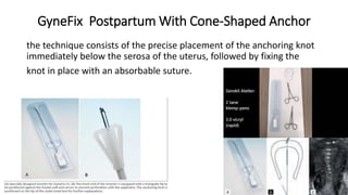 Loop (device orsystem) insertion during cesarean section | PPT