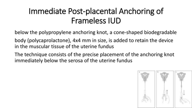 Loop (device orsystem) insertion during cesarean section | PPT
