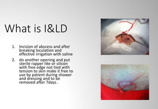 Loop drainage of Abscess | PPTX