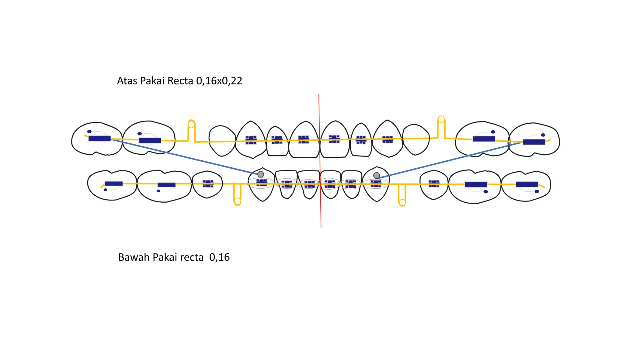 Loop edgewise Nadia untuk design ortodontik | PPTX