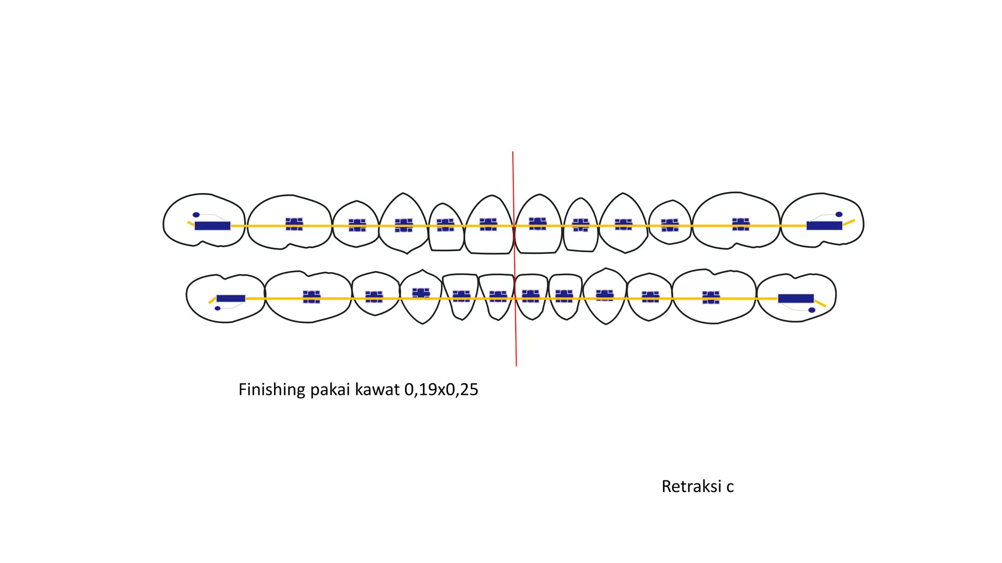 Loop edgewise Nadia untuk design ortodontik | PPTX