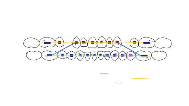 Loop edgewise Nadia untuk design ortodontik | PPTX
