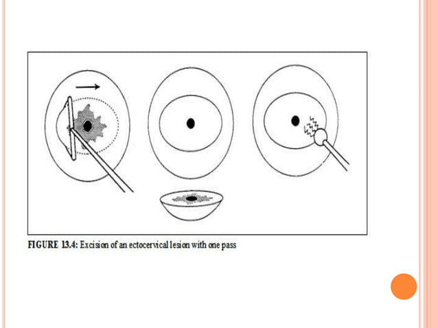 Loop electrosurgical excision procedure | PDF | First Aid | Injuries