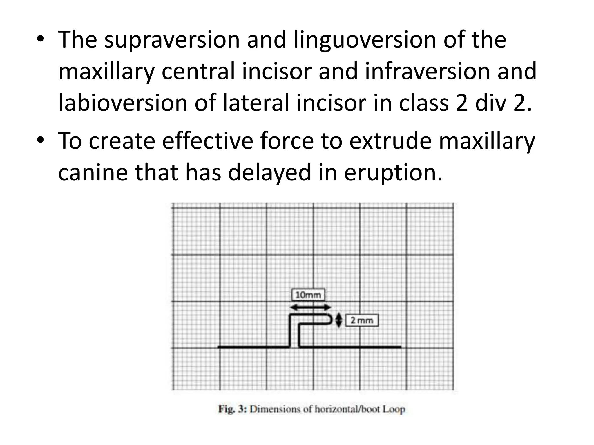Loops In Orthodontics T Loop Bull Loop Vertical Loop Mushroom Loop Stop Loop Pptx Dental