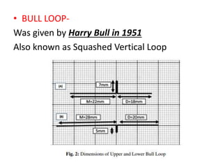 LOOPS in orthodontics t loop bull loop vertical loop mushroom loop stop loop | PPTX | Dental ...