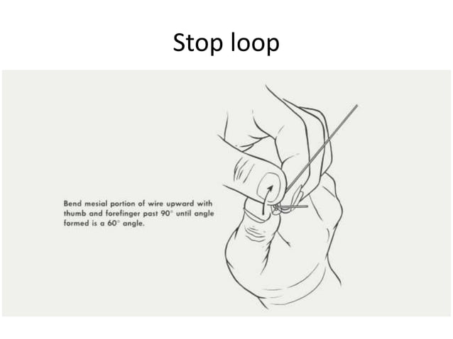 LOOPS in orthodontics t loop bull loop vertical loop mushroom loop stop ...