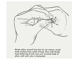 LOOPS in orthodontics t loop bull loop vertical loop mushroom loop stop loop | PPTX