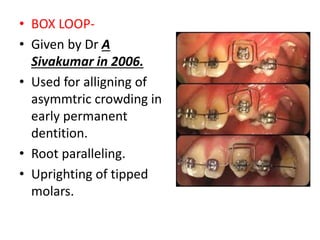 LOOPS in orthodontics t loop bull loop vertical loop mushroom loop stop ...
