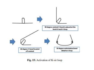 LOOPS in orthodontics t loop bull loop vertical loop mushroom loop stop loop | PPTX | Dental ...